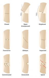 Fracture of pelvic limb in dogs and cats