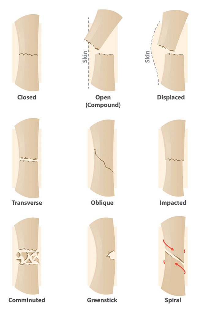 Fracture of pelvic limb in dogs and cats